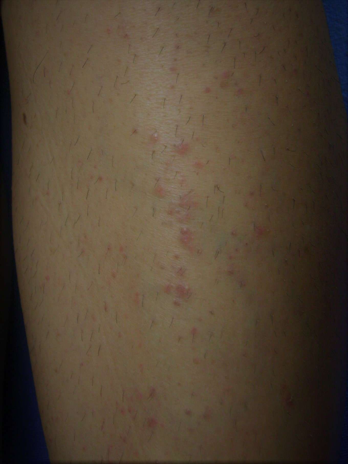 Cosmetic Warts: An Under-recognized Entity! By Dr. Sidharth Sothalia ...