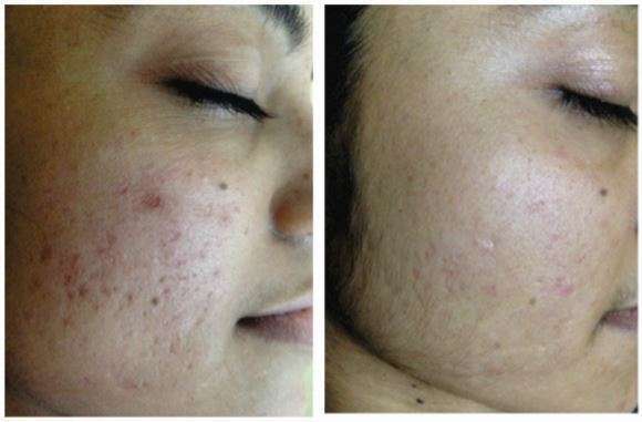 Non-energy Based Treatments of Acne Scaring: A Review By Dr. Mohd. Asif