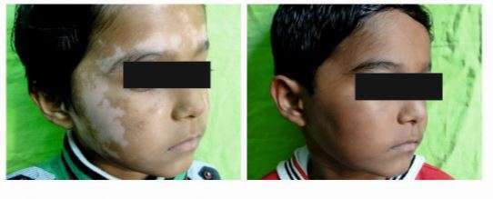 Childhood Vitiligo By Dr. Bhavesh Devani