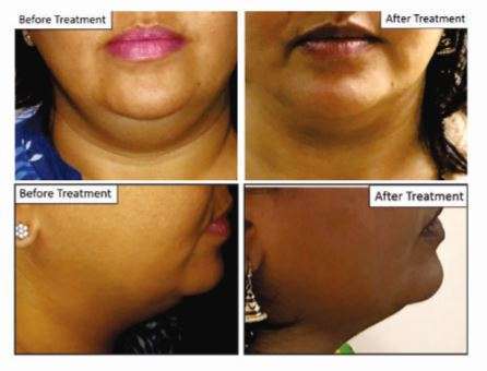 Deoxycholic Acid for Double Chin by Dr. Rupali Pavaskar