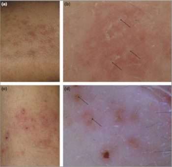 Basics Of Dermatoscopy by Dr. Bhavesh Devani