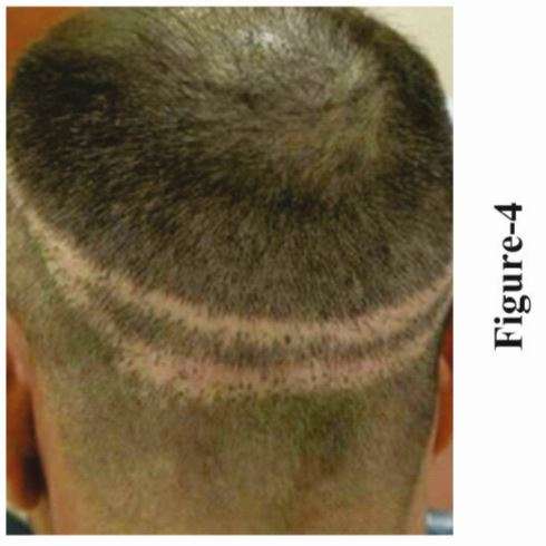Complication And Management In Hair Transplant By Dr. Chandrashekhar Singh