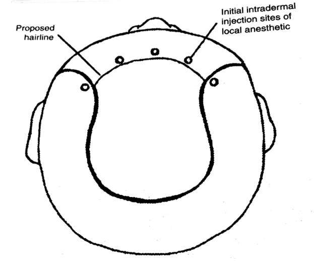 Anaesthesia: Maximizing Patient Comfort & Safety in Hair Restoration